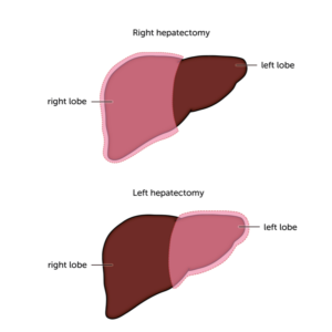 Treatment for bile duct cancer that can be removed - Liver Cancer UK
